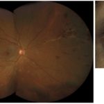Carl Zeiss Clarus 500 Ultra widefield Retinal Camera - Norwood Eyecare